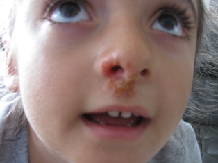 Eczéma | Médecine intégrée