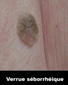 Verrues | Médecine intégrée