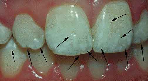 Le fluor | Médecine intégrée
