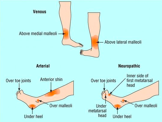 Ulcère variqueux | Médecine intégrée